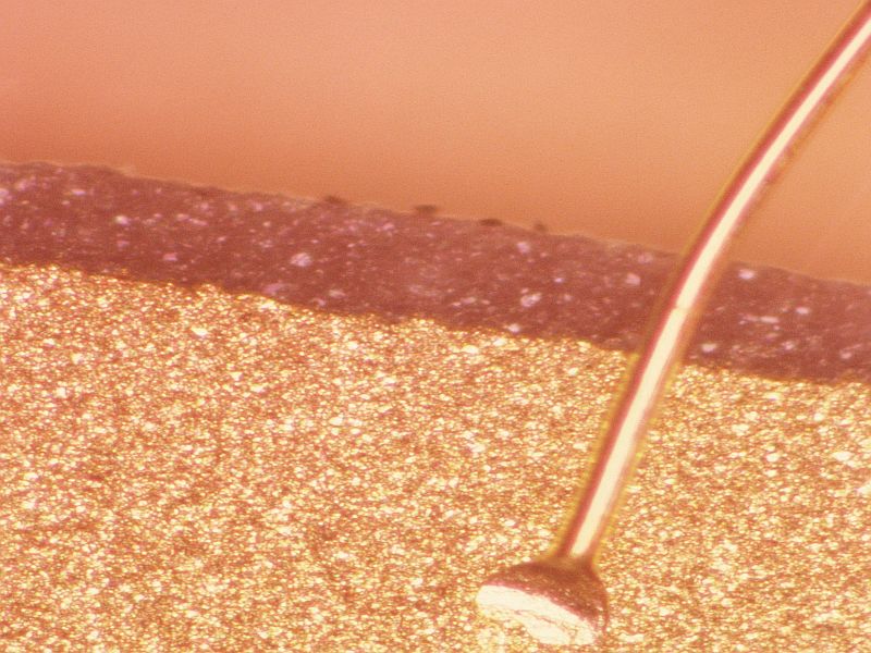 Scientists zero in on cause of rare, disfiguring skin disorder - UPI.com